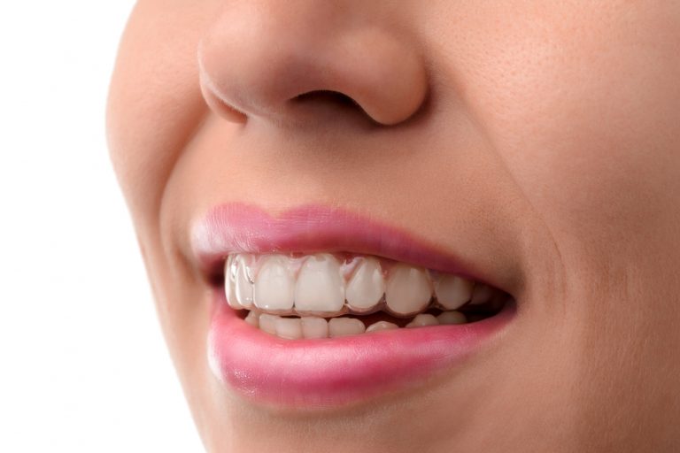 invisalign-braces-example | Aura Orthodontics
